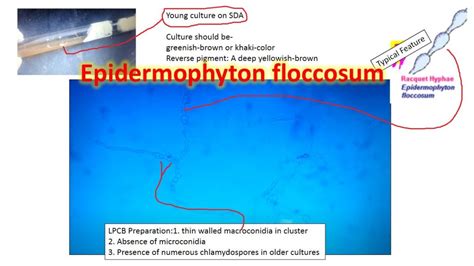 Epidermophyton General Characteristics Pathogenesis Clinical Findings