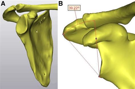 a the 3 dimensional 3d model based on preoperative computed