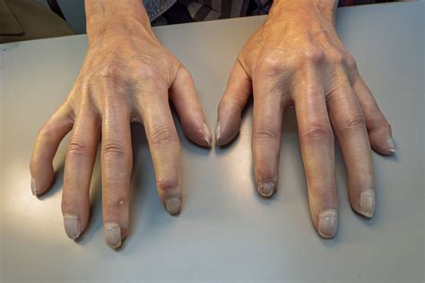 Managing Psychosocial Factors To Improve Physical Function In Systemic Sclerosis