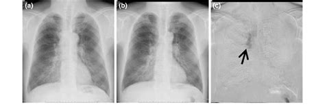 Demonstration Of A Temporal Subtraction Image A Current Image With A Download Scientific