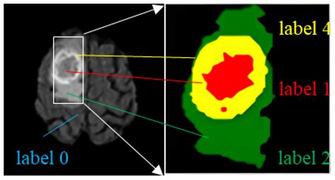 Applied Sciences Free Full Text A Multi Brain Tumor Region