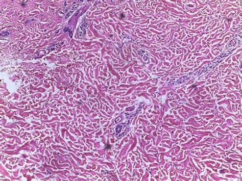Notice The Extension Of Lymphocytic Infiltrate Around Deep Dermal Download Scientific Diagram