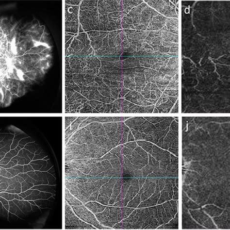 Pdf Diagnosis And Clinical Course Of Ocular Ischemic Syndrome With Retinal Vascular
