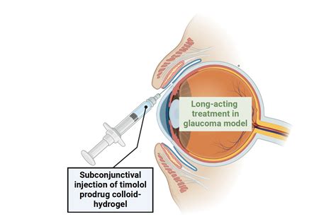 This New Drug Delivery Method Could Offer Long Lasting Relief For Eye Diseases U Of T