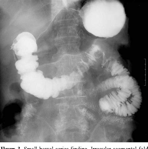 Figure 1 From A Case Of Ischemic Duodenal And Jejunal Enteritis In A Patient With Chronic
