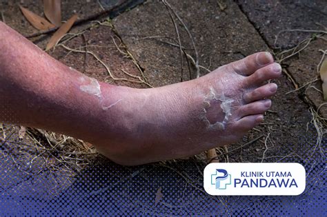 Selulitis Penyebab Gejala Dan Cara Mengobatinya Klinik Utama Pandawa
