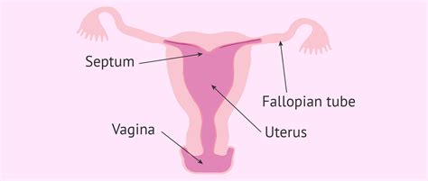 Arcuate Uterus Diagram