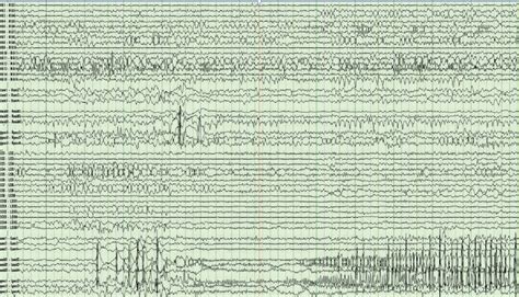 Figure 2 From Electroencephalography In Mesial Temporal Lobe Epilepsy A Review Semantic Scholar