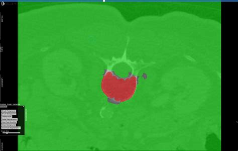 Vertebral Body Segmentation Of A Ct Chest Scan With Fast Growcut In