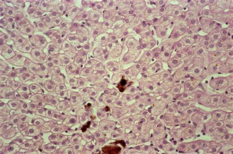 Protoporfiria Eritropoyética Femexer