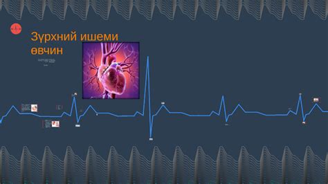 Зүрхний ишеми өвчин болон Цээжний бах By Thelimit Eba On Prezi