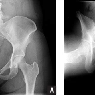Pdf Dermal Burn During Hip Arthroscopy