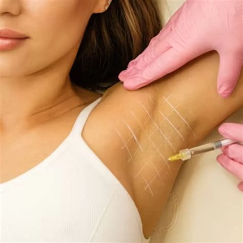 Botox For Hyperhidrosis Excessive Sweating Koreabeauty Guide