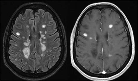 Magnetic Therapy For Multiple Sclerosis At Travis Poteete Blog
