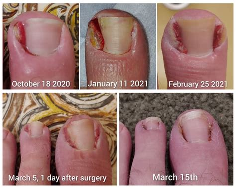 Progression And Recovery After Surgery Ringrowntoenails