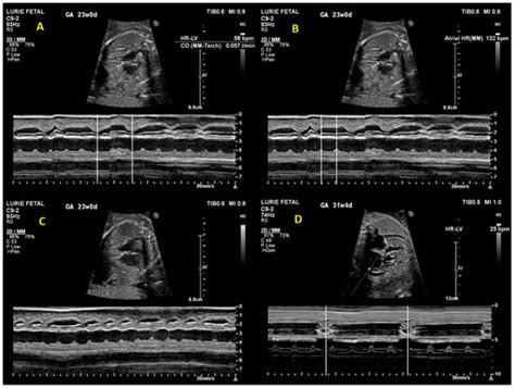 Fetal Congenital Complete Heart Block A Rare Case With An Extremely