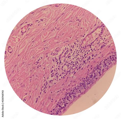 Microscopic Image Of Branchial Cyst Branchial Sinus Show Cyst Wall Of Fibrocollagenous Tissue