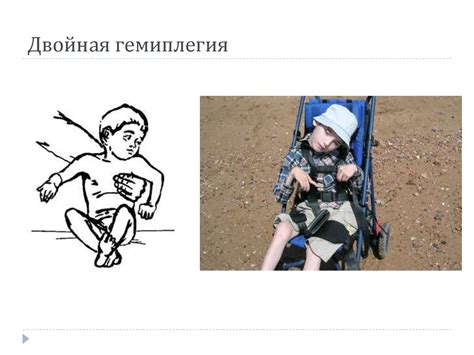 Детский церебральный паралич ДЦП презентация онлайн