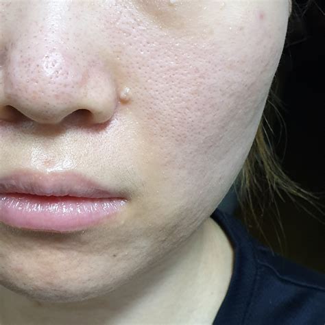 코 옆에 있는 튀어나온 점 함희정성형외과