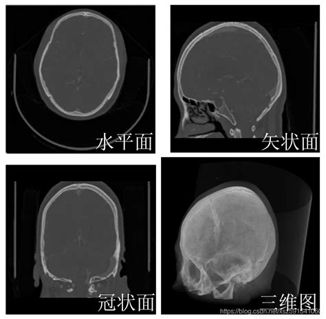 （医学三维重建）matlab体绘制算法：多层面重建（mpr）mri重建matlab代码 Csdn博客