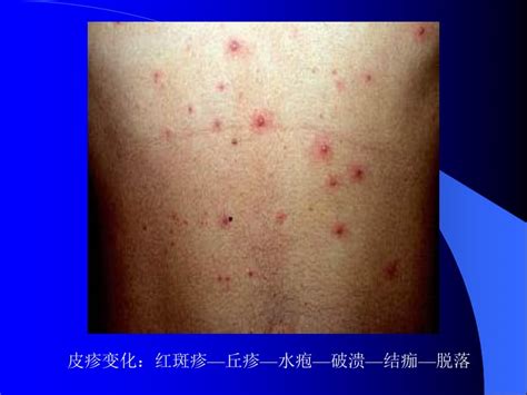 出疹性疾病的诊治ppt课件 文件