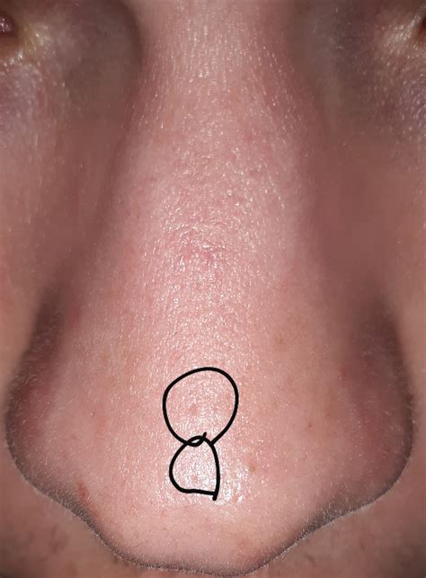 Scars On Nose Scar Treatments Acne Org Forum