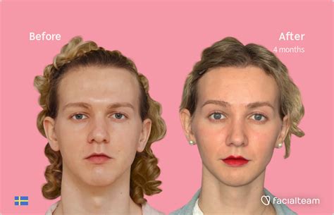 Facial Feminisation Surgery For Uk Patients