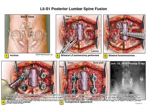 L5 S1 Posterior Lumbar Spine Fusion Medivisuals High Impact