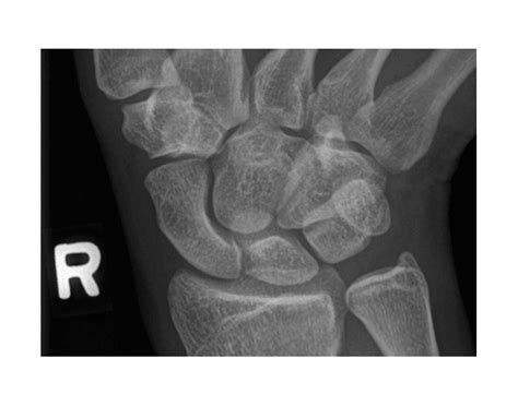 Pa Scaphoid With Ulnar Deviation Quiz