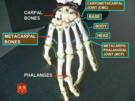 Fourth Metacarpal Shaft Fracture Rxharun