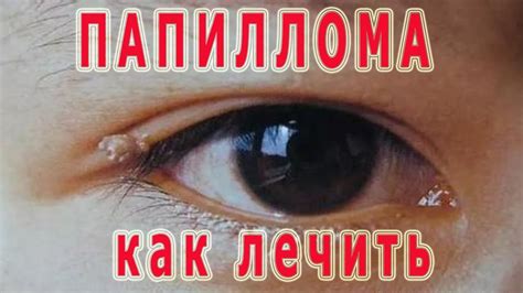 ★ПАПИЛЛОМА. Причины ВПЧ. Методы лечения. УДАЛЕНИЕ ПАПИЛЛОМ. - YouTube