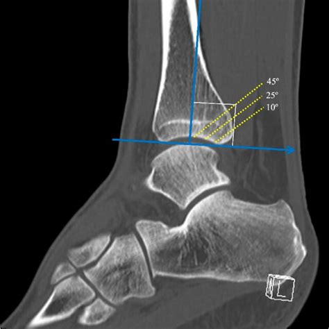The Angle Between The Fracture Line And The Z Axis On The Sagittal Download Scientific Diagram
