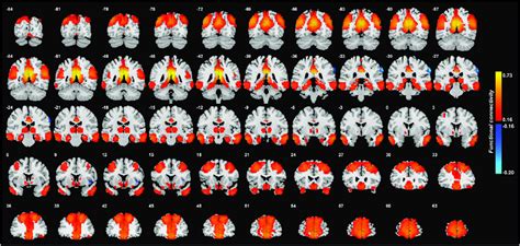 Functional Connectivity Of The Posterior Cingulate Cortex In 350