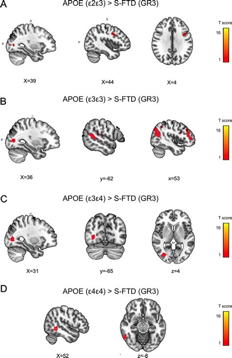 Atrophy Pattern Of Gr2 Patients With Apoe Risk Variants ε2ε3 ε3ε3