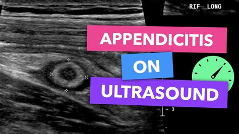 Appendicitis On Ultrasound Radiopaedias Emergency Radiology Course Youtube