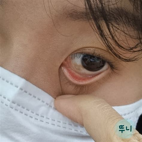 결막모반 제거 눈알 점 눈동자 점 제거 후기 결막모반 수술 후 일주일 네이버 블로그
