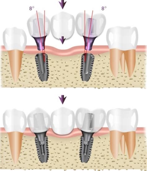 Acceptable Implant Divergence Angle Measured As The Sum Of Internal
