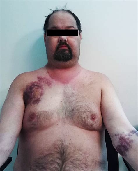 Which Condition Causes Moon Face” A Addison Disease B Cushing