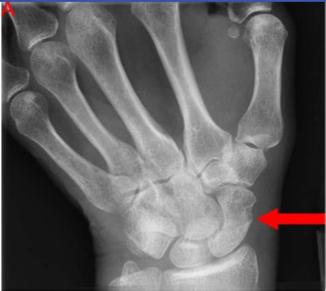 Pin On Fractures