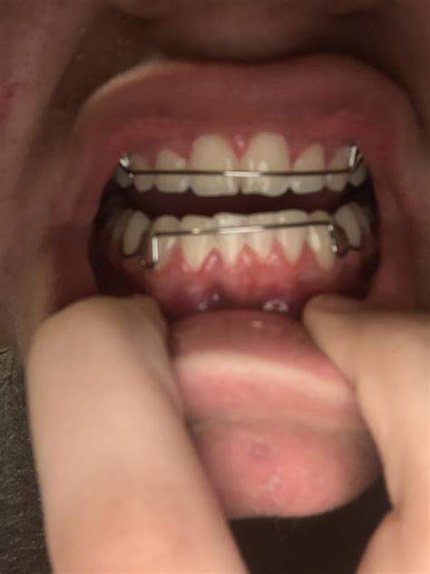Retainer For Bottom Teeth