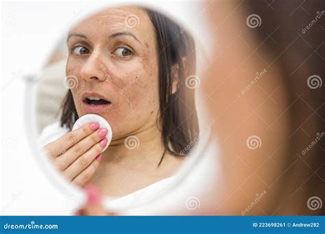 Skin Problems Young Woman Holding A Small Porter And Making A Royalty