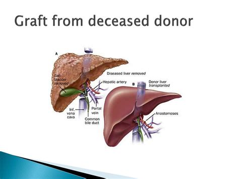 Ppt Liver Transplantation Powerpoint Presentation Free Download Id