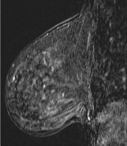 Hormonal Effects On Breast Density Fibroglandular Tissue And