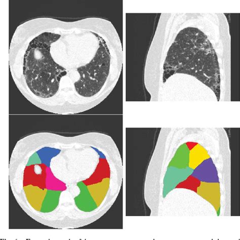 Figure 2 From Automatic Segmentation Of Pulmonary Segments From