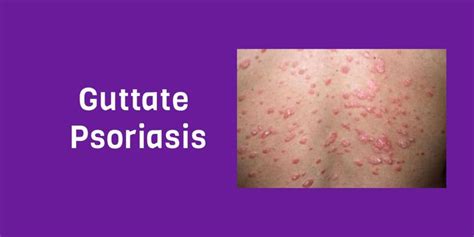 Guttate Psoriasis Medizzy