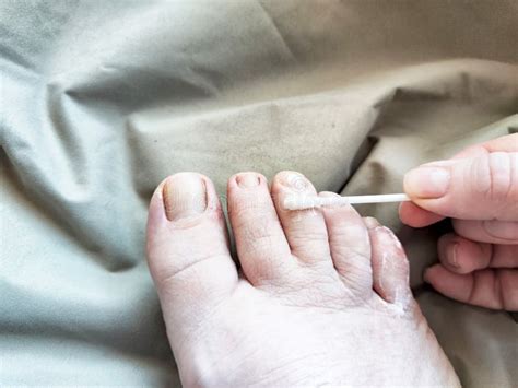 Applying Antifungal Treatment To Foot With Fungus Infection For