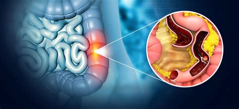 You Have Colon Polyps Now What Health News Hub