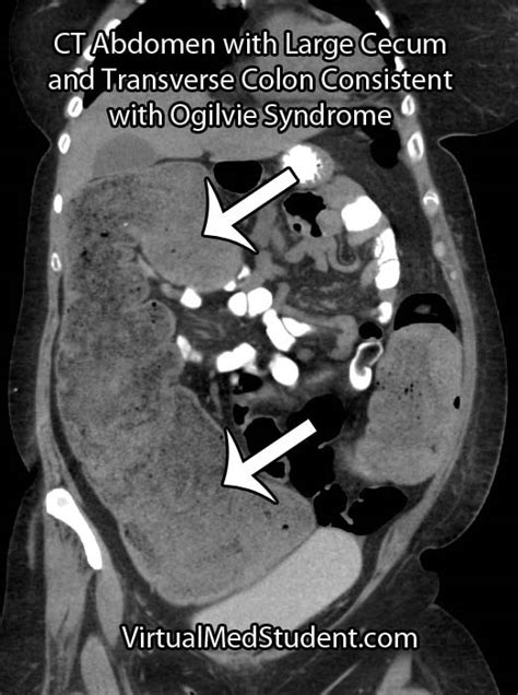 Sir William Ogilvie And His Syndrome Colonic Pseudo Obstruction