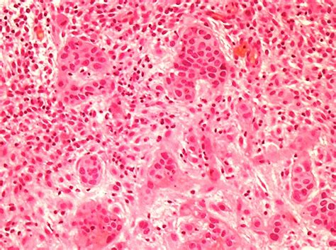 Pathology Outlines Epithelioid Trophoblastic Tumor