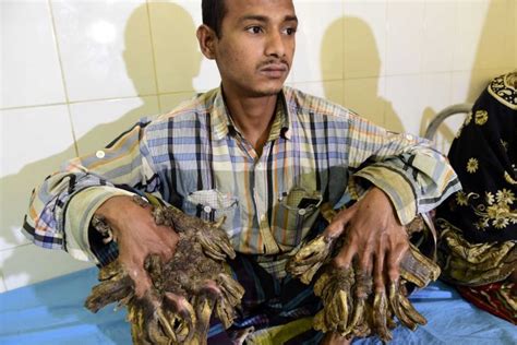 Tree Man Disease An Illness With No Cure Yet Bangladeshis Tree Man To Undergo Surgery Kanigas